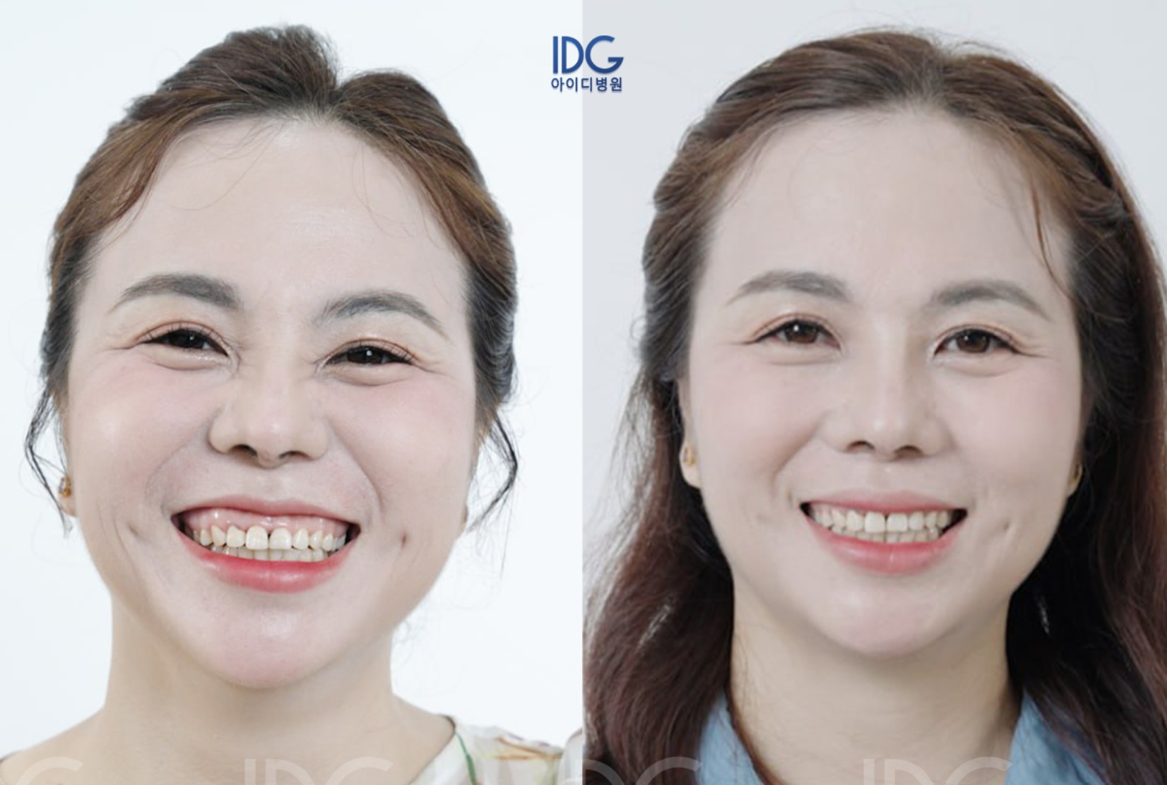 Hành trình thay đổi nụ cười với Gummy Smile Fill tại Trung tâm CNC IDG
